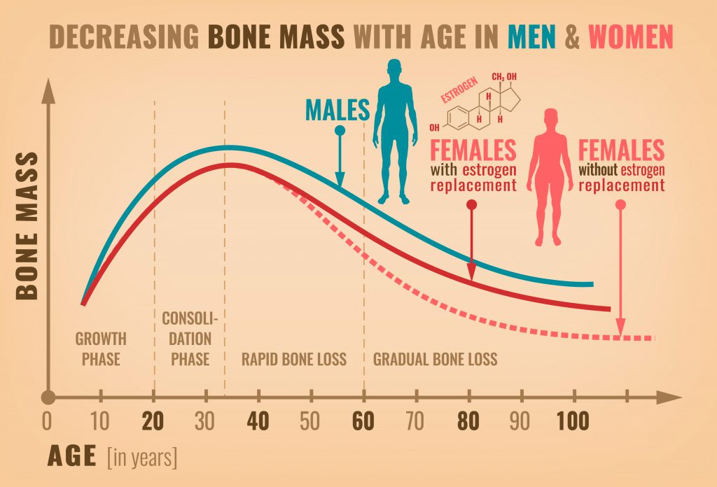 No Bones About It: Osteoporosis Affects Men, Too | Urgent Team - Family ...