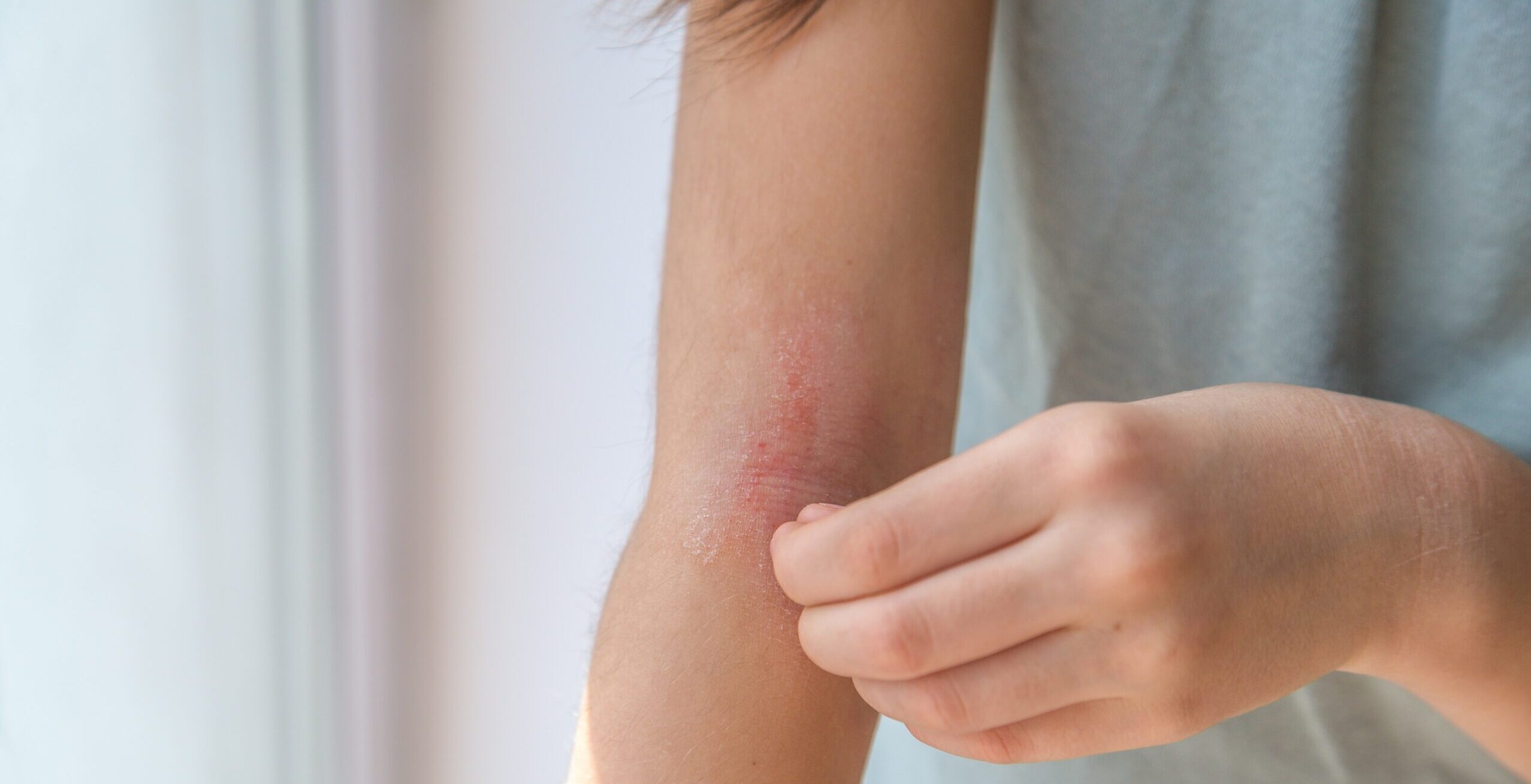 Easing the Effects of Eczema | Urgent Team - Family of Urgent Care and ...